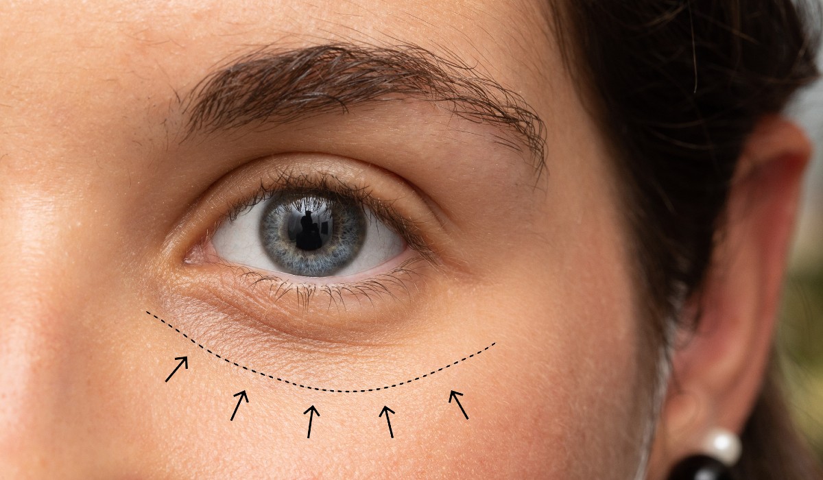 Alternatives to Botox for under Eye Wrinkles | Buyers Report